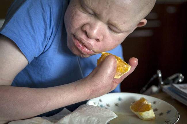Meet Baraka Cosmas Lusambo, whose albino arms were chopped off by witch ...