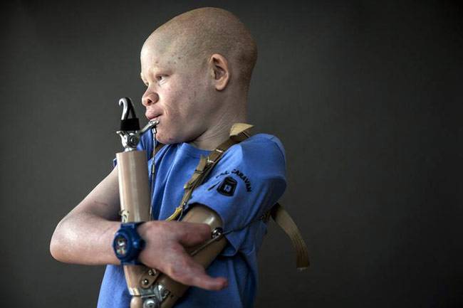 Meet Baraka Cosmas Lusambo, whose albino arms were chopped off by witch ...