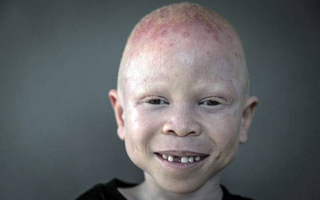 Meet Baraka Cosmas Lusambo, whose albino arms were chopped off by witch ...