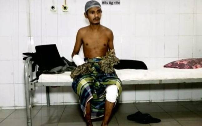 Bangladesh's 'Tree Man' undergoes surgery - India Today