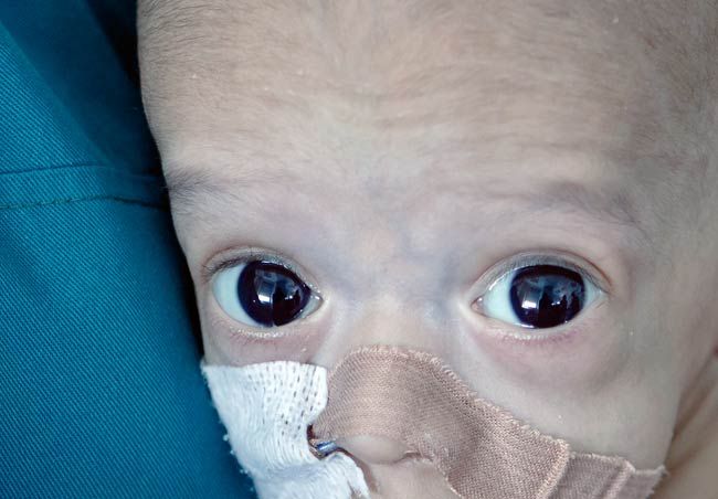 Romanian baby survives without intestines | IndiaToday