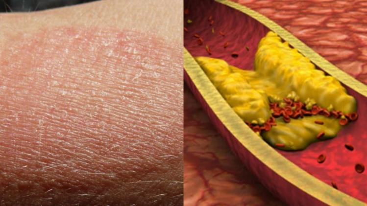 High Cholesterol Sign: কোলেস্টেরল বাড়লে ত্বকে একটি পরিবর্তন দেখা যায় ...