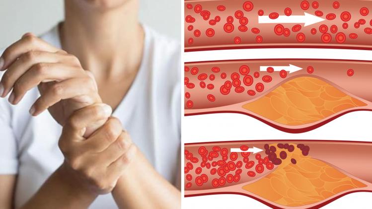 Cholesterol Warning Sign: কোলেস্টেরল বাড়ার এই ৯ লক্ষণ দেখা দেয় শরীরে ...