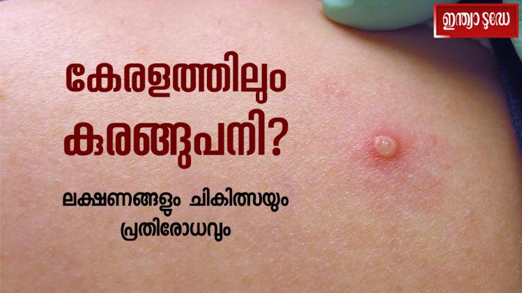 Monkeypox: കേരളത്തിലും കുരങ്ങുപനി? ലക്ഷണങ്ങളും ചികിത്സയും പ്രതിരോധവും ...