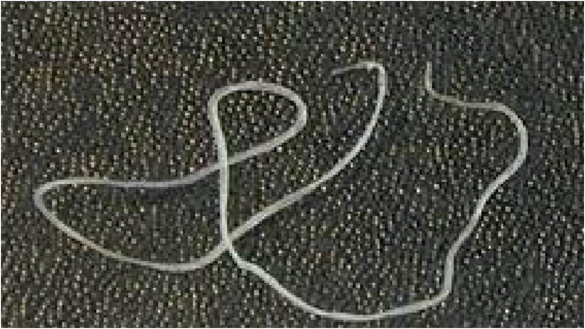 Long-lived worms in eye: 58 വയസ്സുകാരിയുടെ കണ്ണിൽ 11 സെന്റിമീറ്റ ...