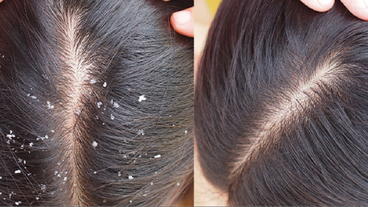 How to treat excess dandruff with home remedies - How to treat excess ...