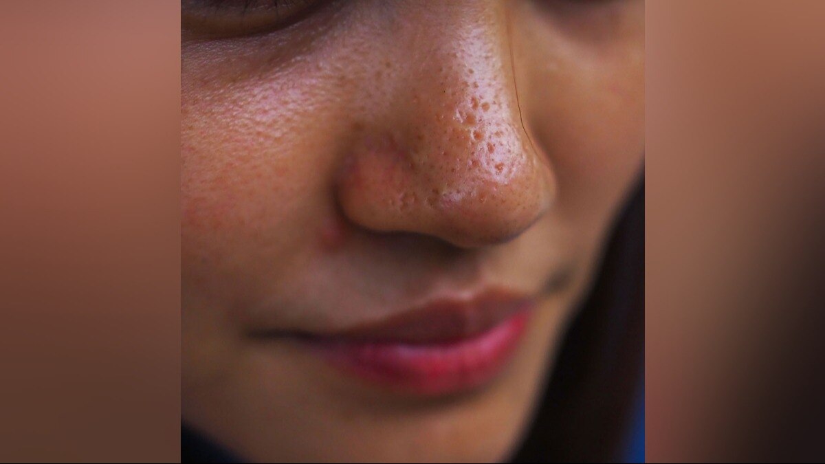 Managing Excess Facial Oil During Summers: Home Remedies and Tips ...