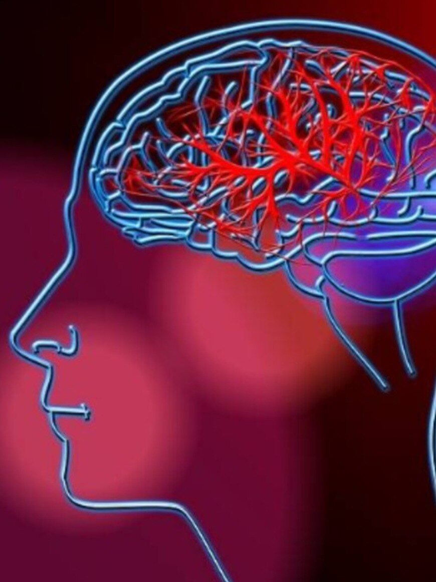 Brain stroke symptoms and prevention sus