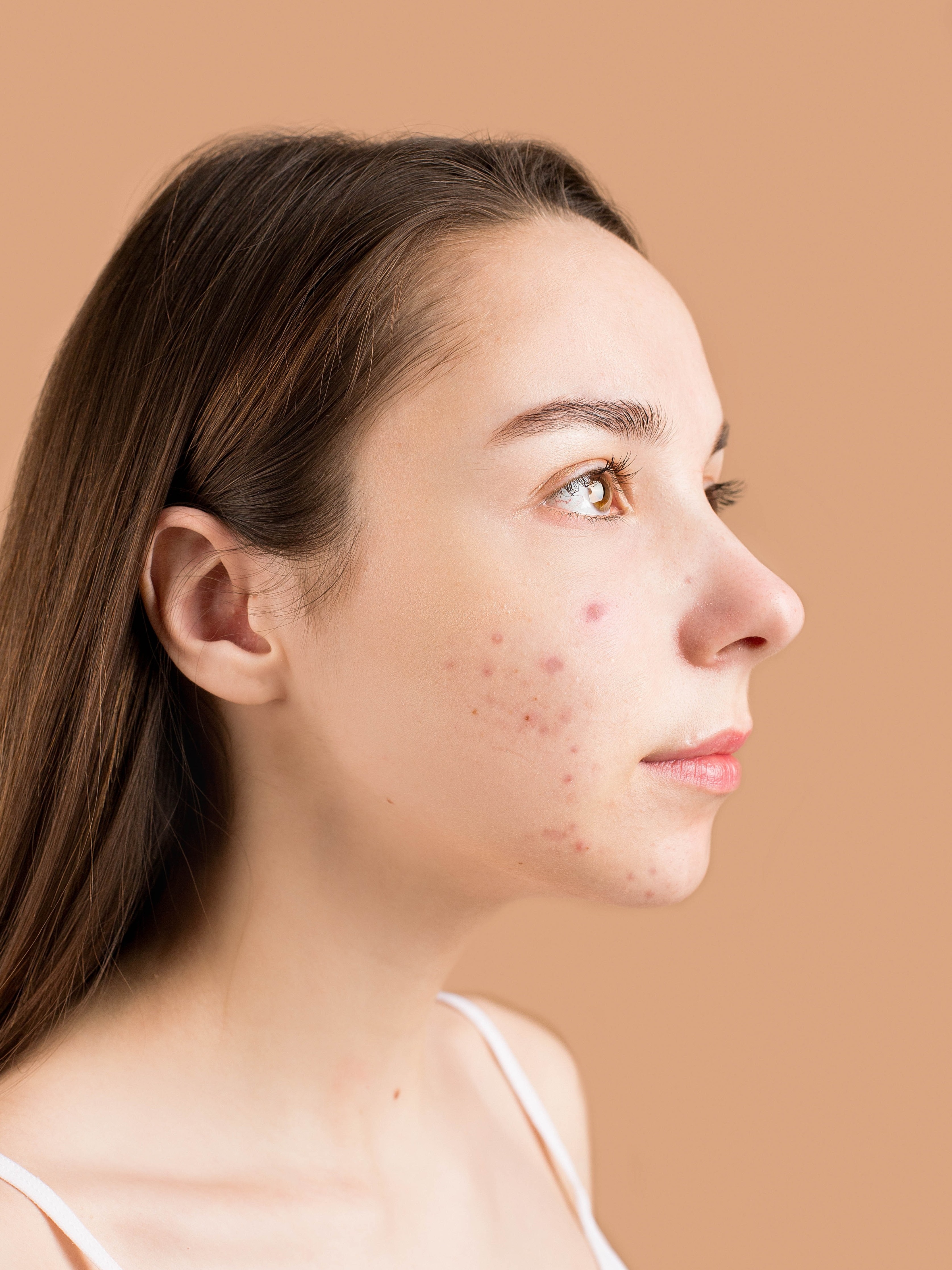 5 Tips To Get Rid Of Acne Spots